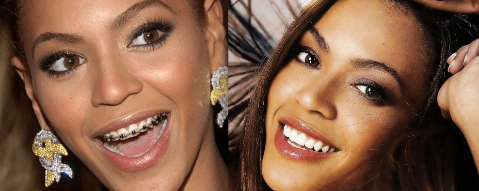 Famosos con brackets | Clínica Dental Rob Badalona